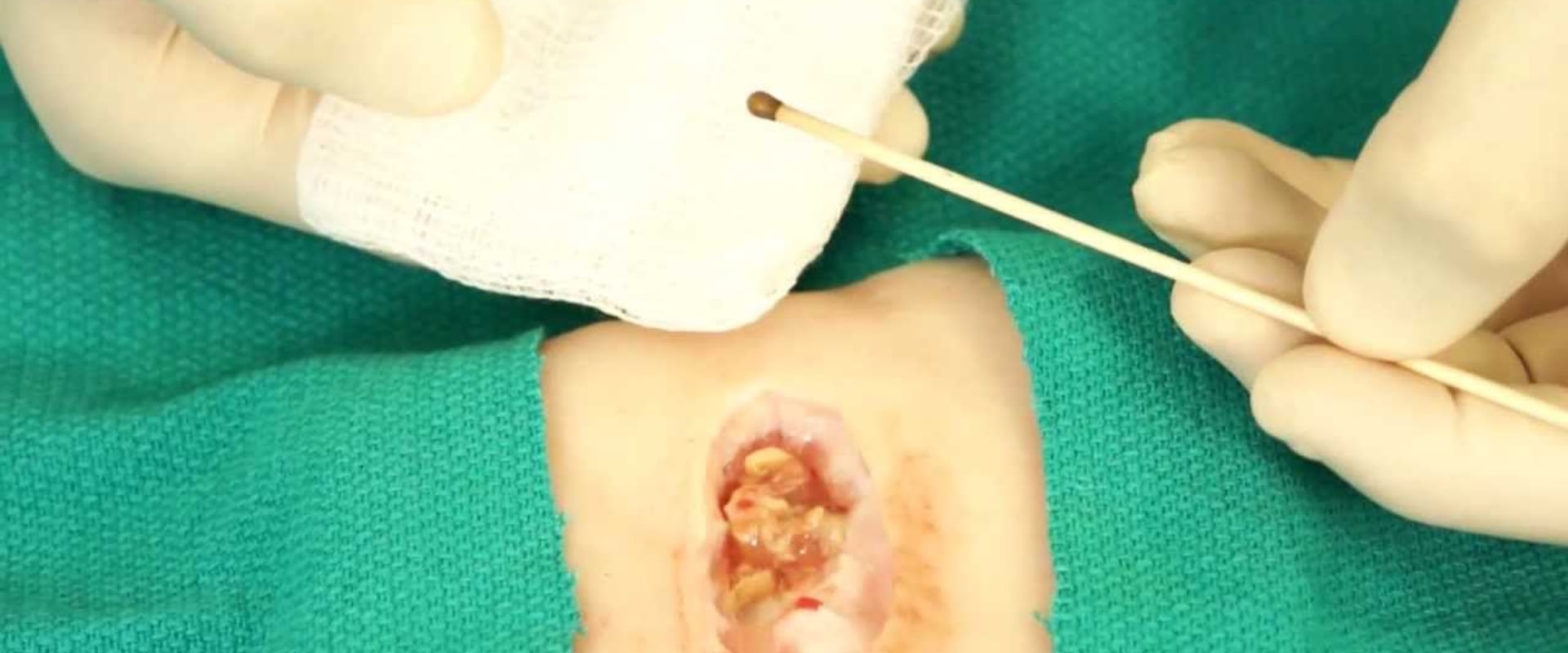 How to Recognize What Dissolvable Stitches Look Like When Combined With ...