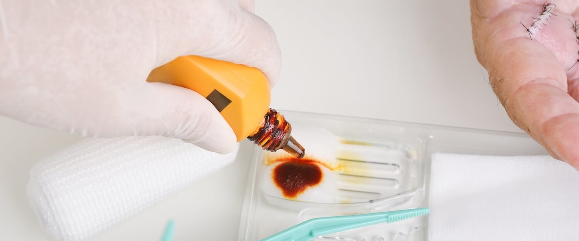 The Benefits Of Silver Nitrate In Types Of Wound Dressing For Faster ...