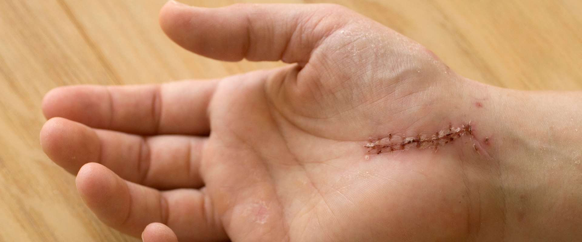 Scar Tissue Pain After Injury? Find Out Why It Hurts