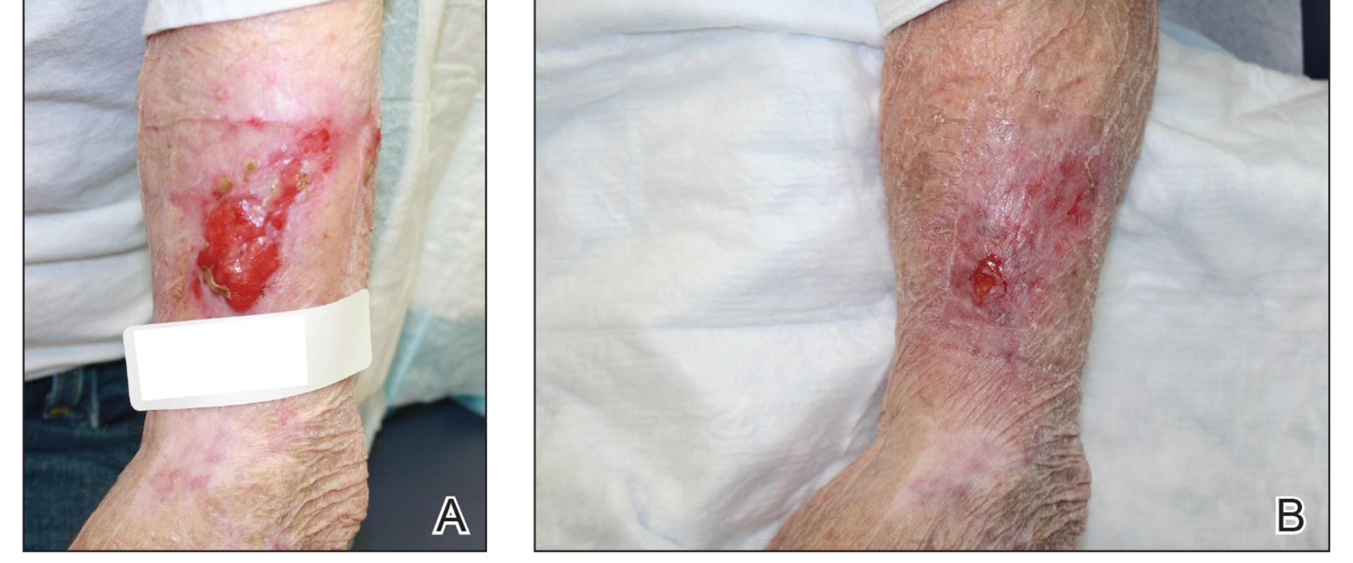 Boosting Surgical Incision Wound Healing Stages With Silver Nitrate ...