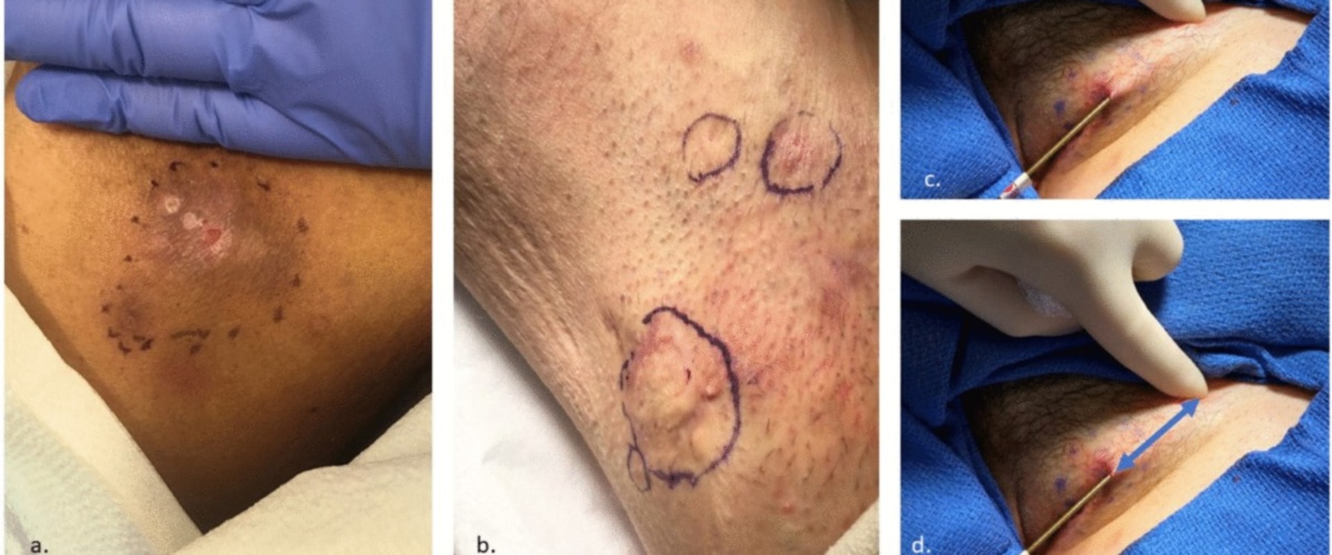 Exploring Effective Treatments For Types Of Skin Tunneling Wounds With ...