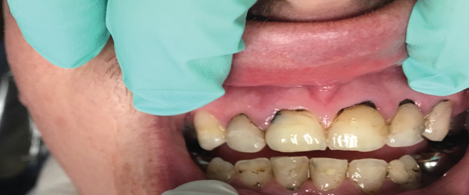 The Uses and Benefits of Silver Nitrate in the Medical Community