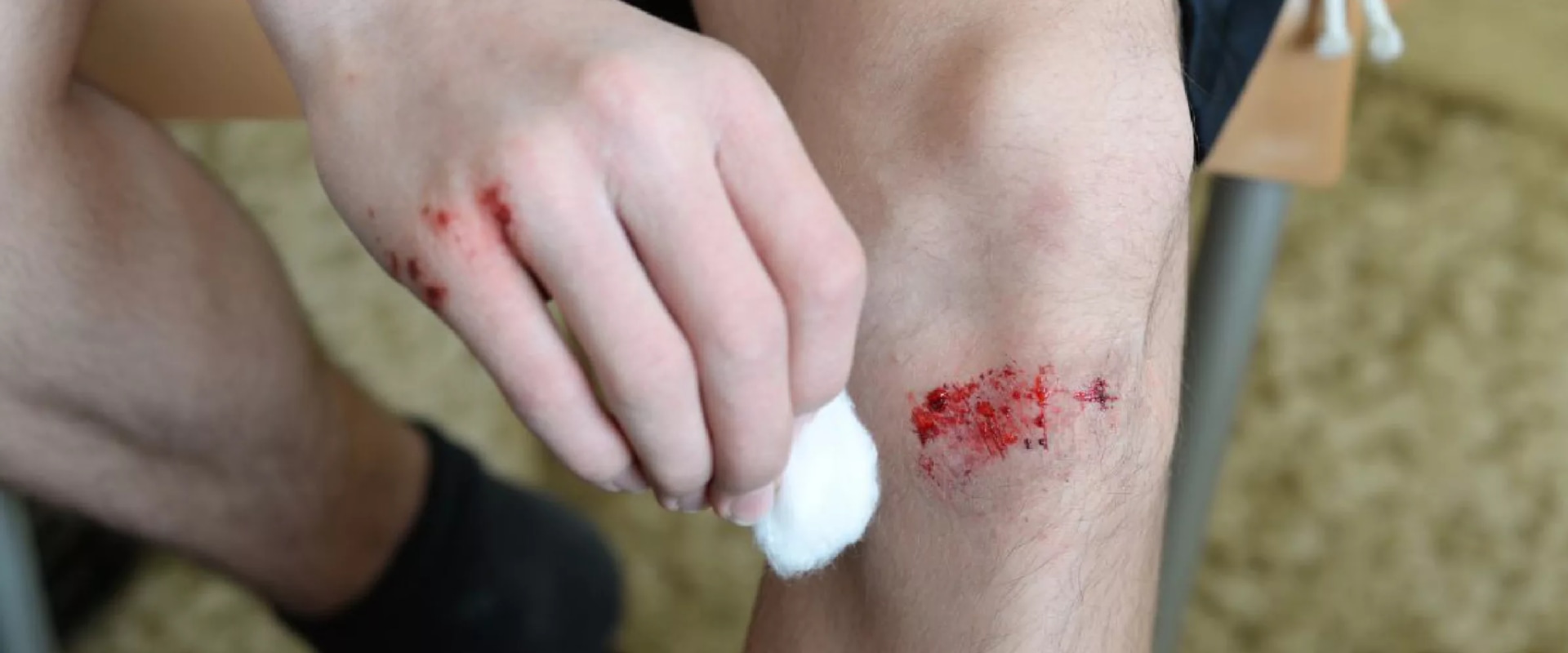 Laceration Vs Abrasion: What's the Difference and How Silver Nitrate Can Speed up Healing