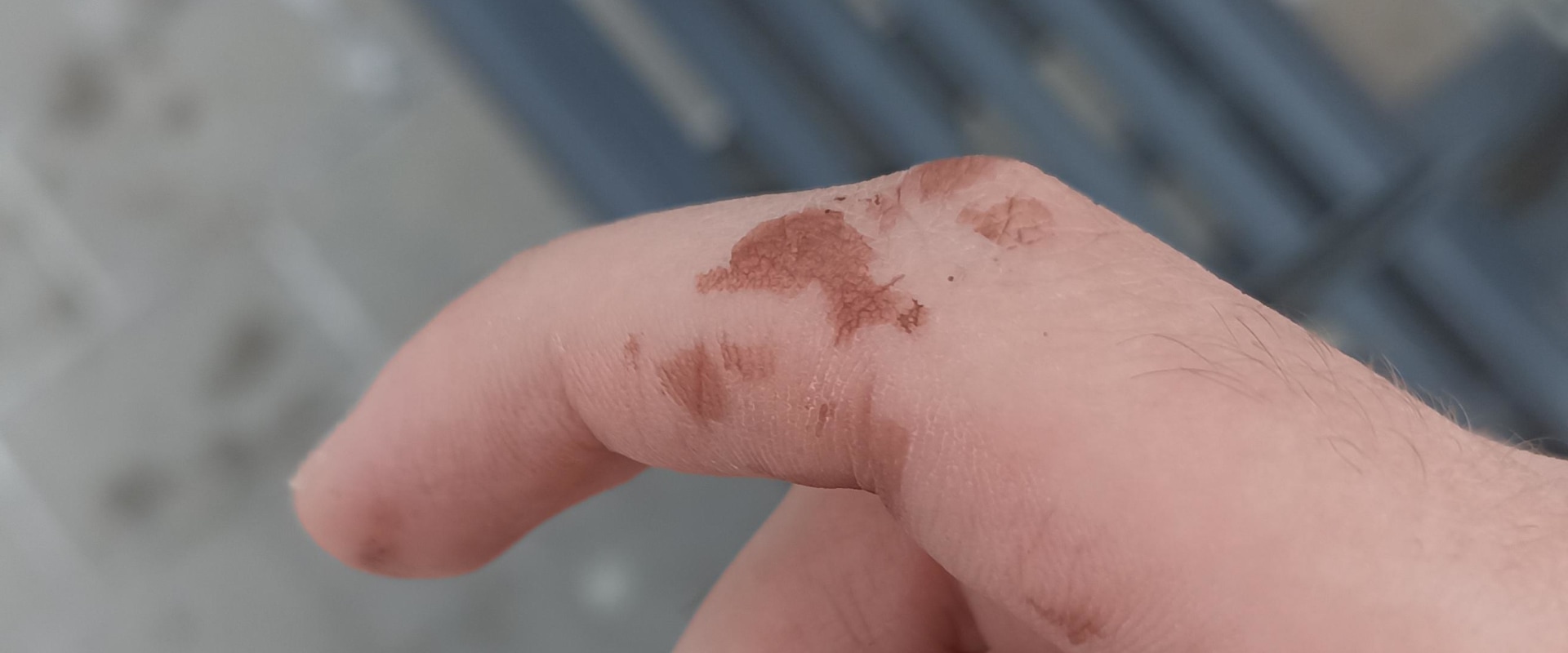 The Hidden Dangers of Silver Nitrate on Skin